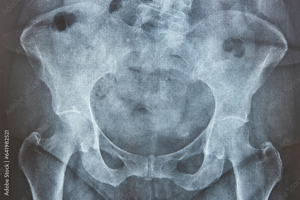 Hip xray. Human skeleton. Pelvis and femur bone. Osteoporosis Stock ...