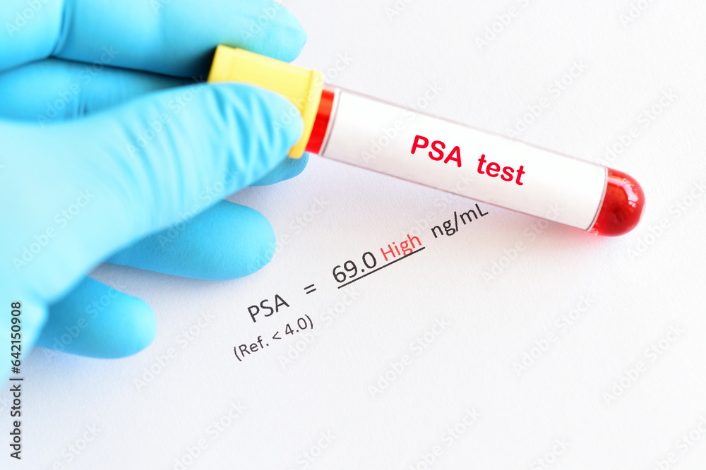 Abnormal high PSA test result with blood sample tube Stock Photo ...