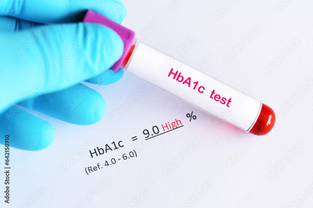 Abnormal high HbA1c test result with blood sample tube Stock Photo ...