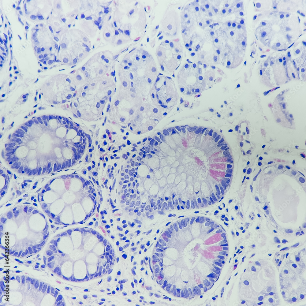 Paneth Cell Metaplasia
