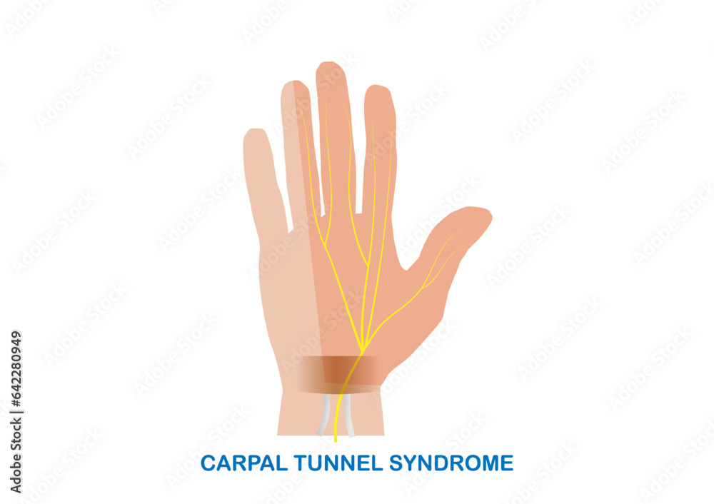 Vector illustration of median nerve entrapment at the wrist or carpal ...