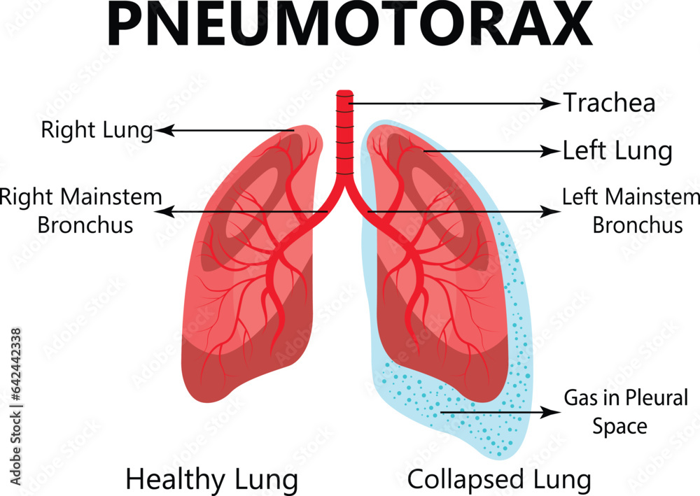 Pneumonia. The anatomical structure of the human lung. Vector ...