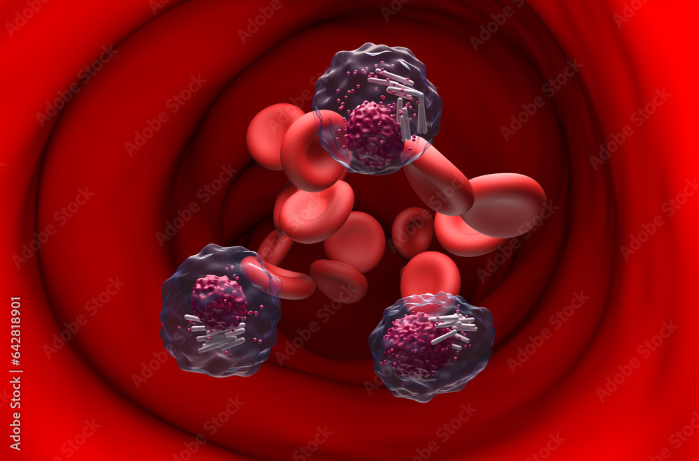 Chronic lymphocytic leukemia (CLL) cells in blood flow - section view ...