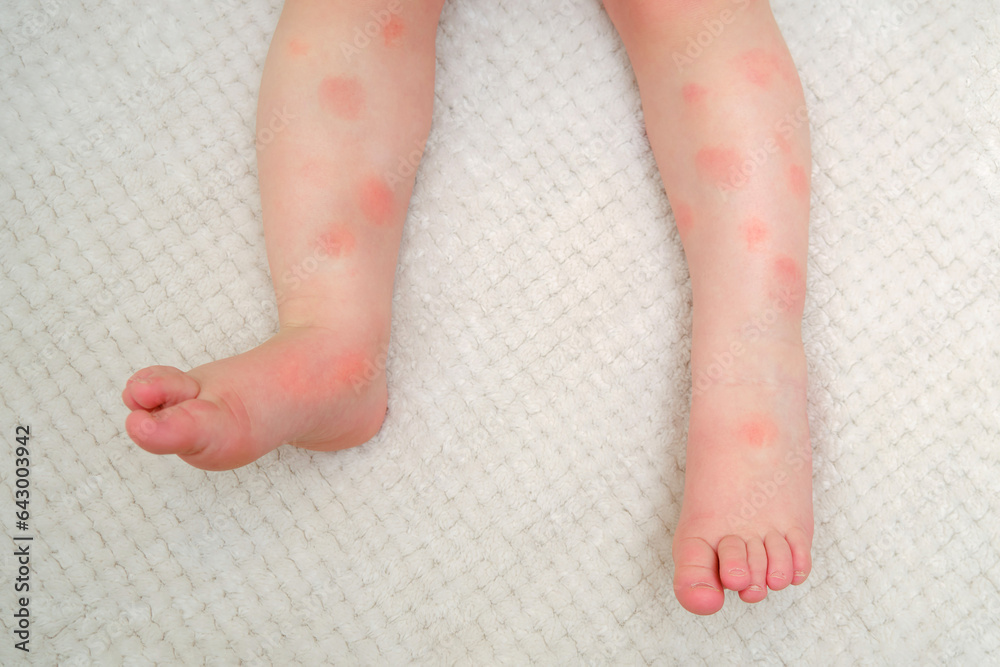 Toddler baby skin care, allergies and dermatitis. Red spots of allergy ...