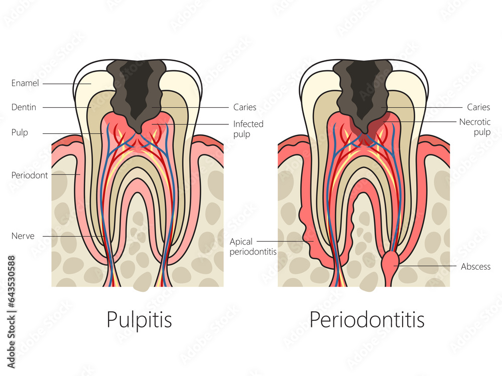 Pulpitis and periodontitis in human teeth diagram schematic raster ...