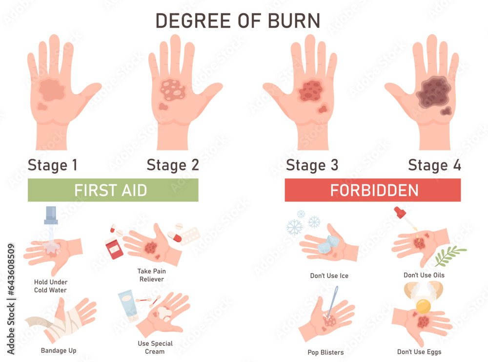 Degree of skin burn infographic poster with first aid and forbidden ...