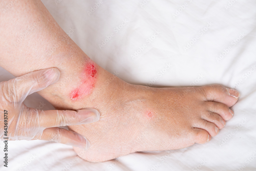 healing of injured limb, doctor treats healing wound on leg adult ...