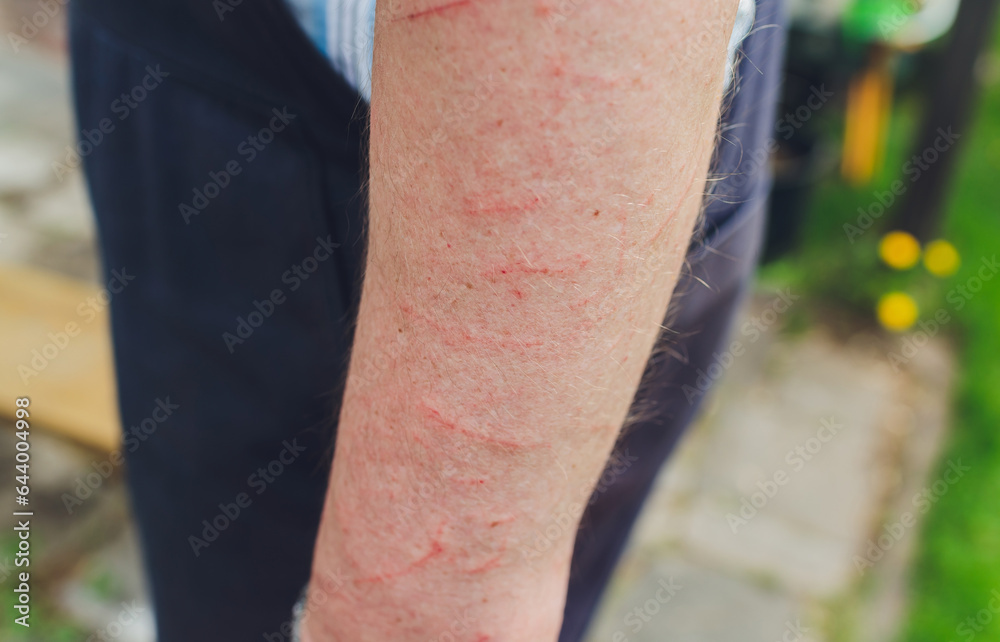 Skin allergy diseases problem, Poison tree contact dermatitis rash by ...