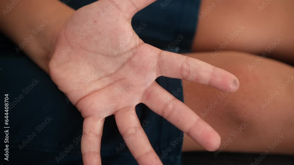 Close up rashes and ulcers on the palms of the child. Childhood ...