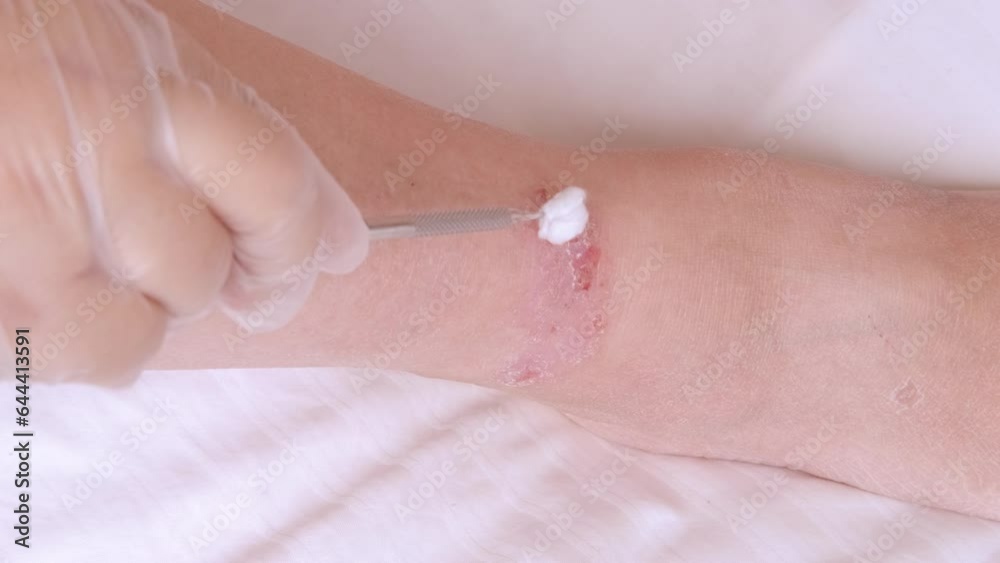 healing of injured limb, doctor treats healing wound from on leg ...