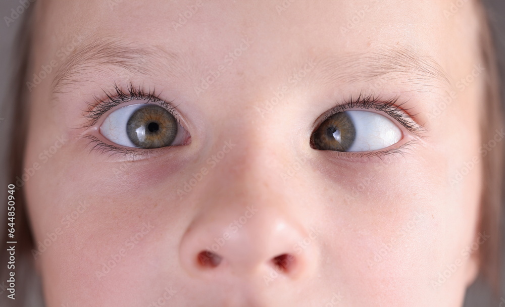 Child's face with squint and freckles on nose. Strabismus in children ...