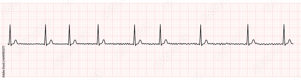 EKG Monitor Showing Atrial Fibrillation With Normal Ventricular Response Stock Vector | Adobe Stock