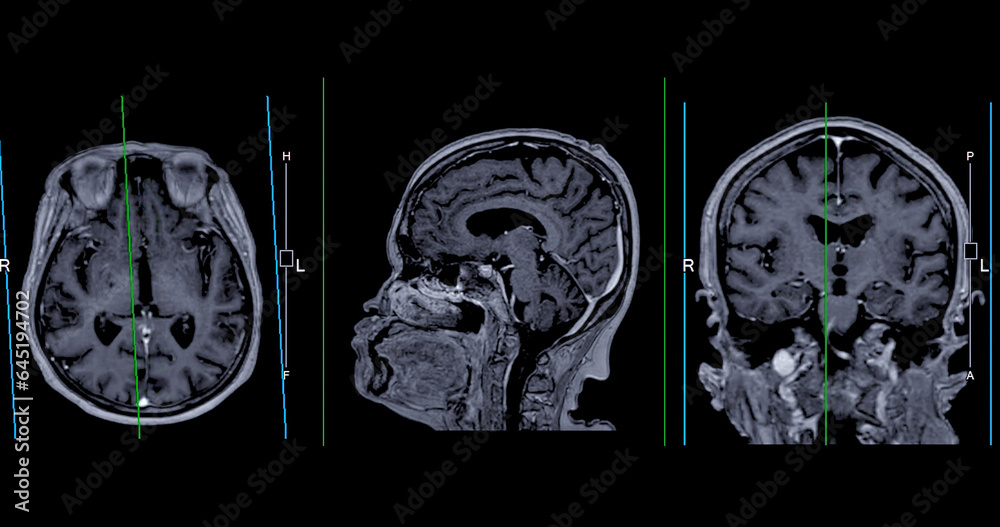 MRI brain scan Axial , Coronal and sagittal view with referance line ...