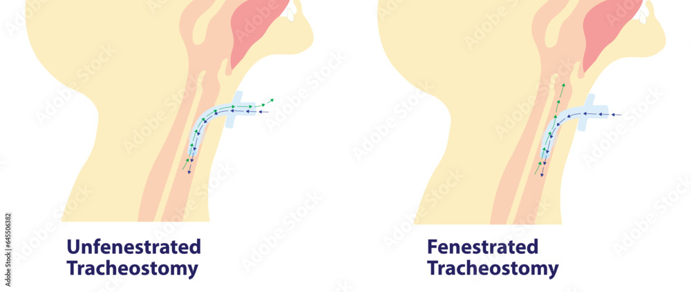 Fenestrated and unfenestrated tracheostomy air flow ilustration. Side ...
