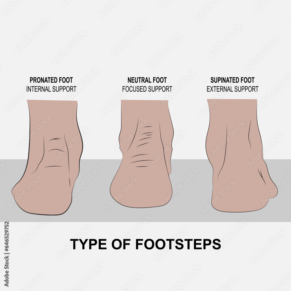three types of human footprints pronator, supinator and neutral Stock ...