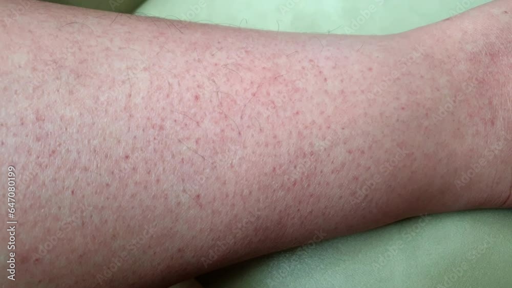 Red blood rash spots on skin dengue fever symptom mosquito tropical disease vídeo do Stock ...