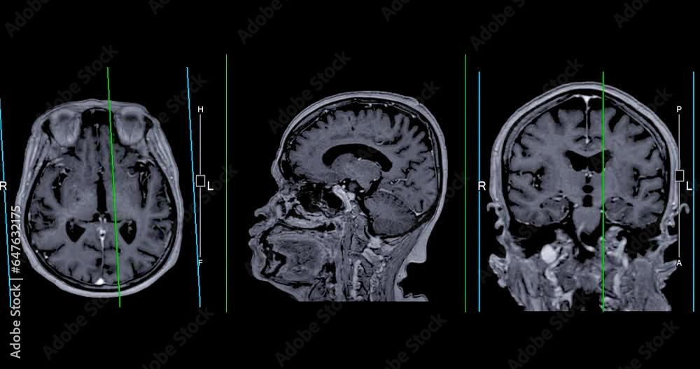 MRI Brain with reference line can help doctors look for conditions such ...