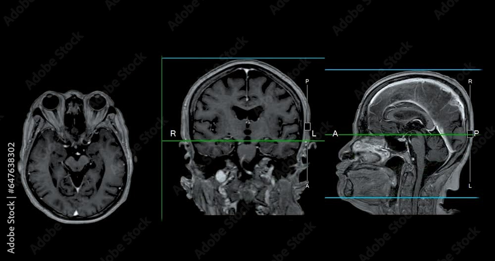 MRI Brain with reference line can help doctors look for conditions such ...