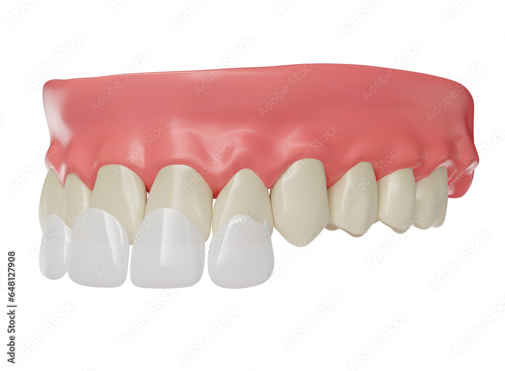 Realistic teeth with lenses and gums in on transparent background in 3d ...
