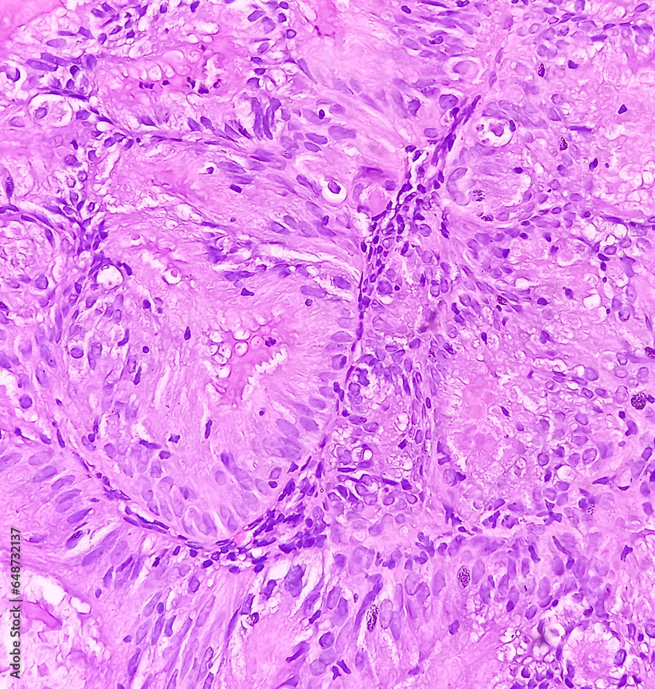 Endometrial adenocarcinoma. Uterus cancer. Uterine papillary serous ...