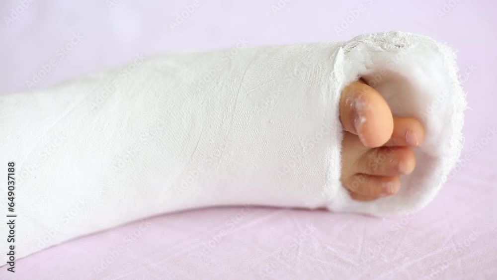 Broken leg in a orthopedic cast of an young child. A unrecognizable ...