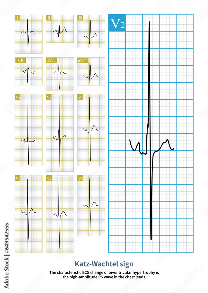 A 4-year-old male patient was clinically diagnosed with atrial septal ...