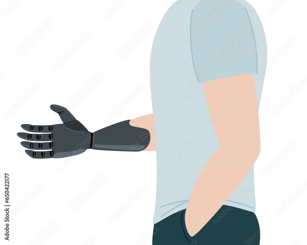 Man with prosthetic arm. Bionic limb, amputee male person. Concept of ...