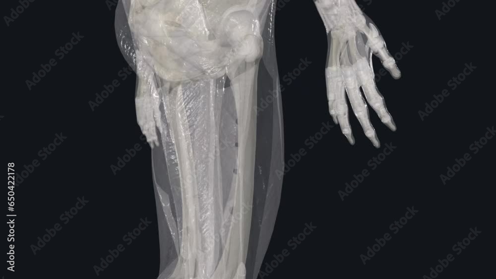 The superficial transverse metacarpal ligament (natatory ligament) is a ...