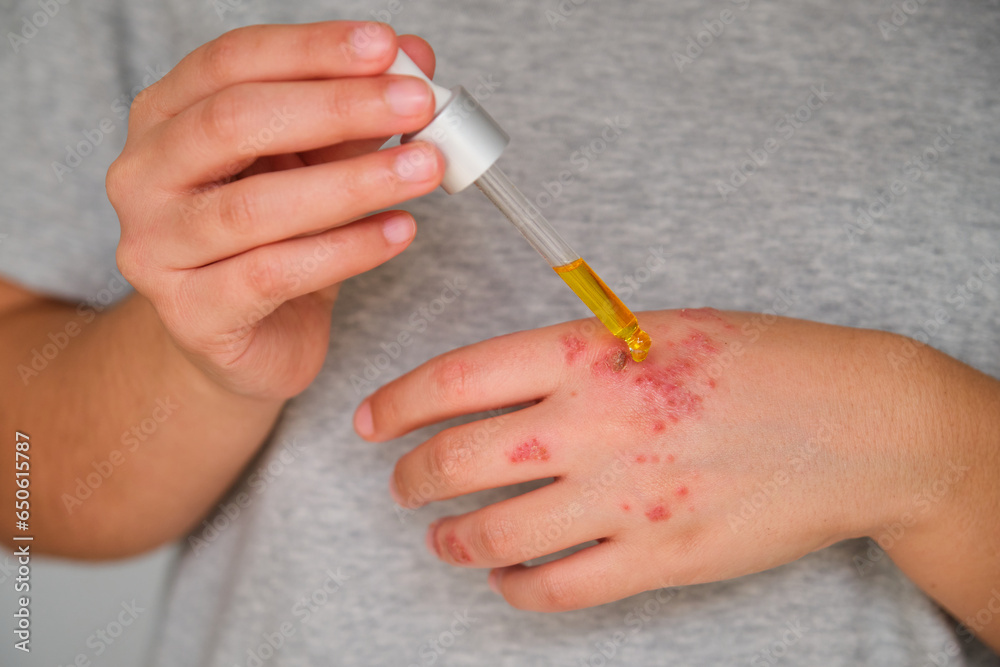 Patient hands applying rosehip oil on eczema. Dermatitis, atopic skin ...