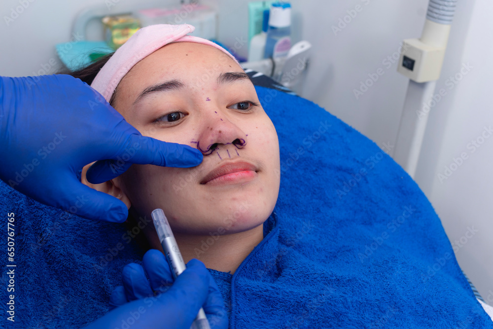 A cosmetic surgeon drawing lines on the alars of a pateint's nose ...