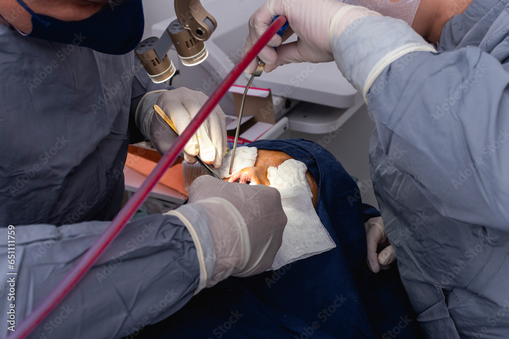 A cosmetic surgeon assisted by a nurse cuts and removes alar tissue ...