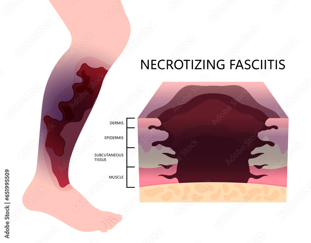 Leg injury with skin infection of Necrotizing fasciitis cause limb pain ...