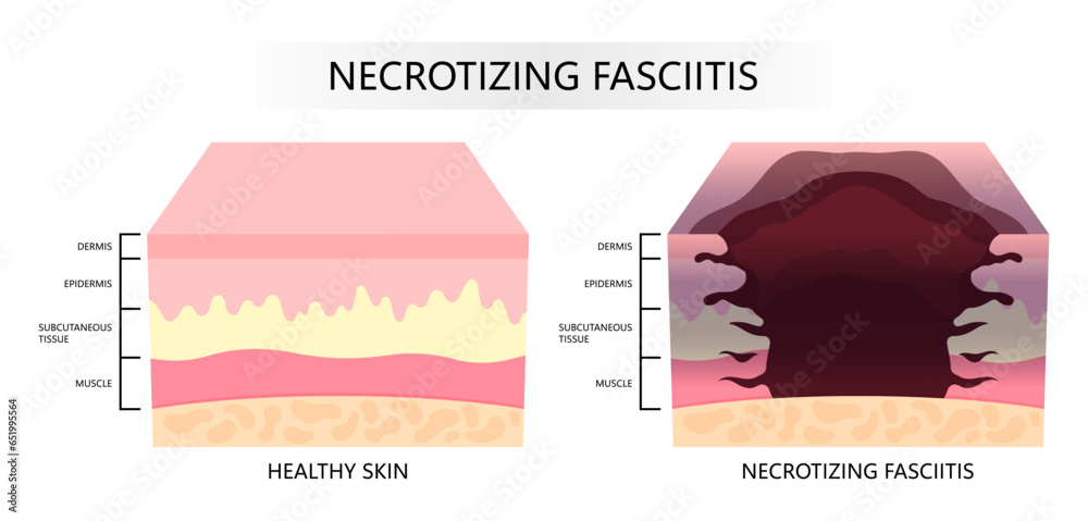 Epidermis layer of the skin with bacteria Necrotizing fasciitis ...