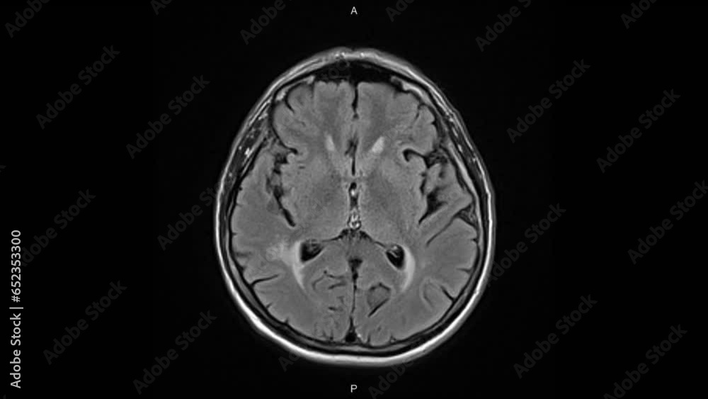 Magnetic resonance imaging of the brain. MRI of the brain. Medical ...