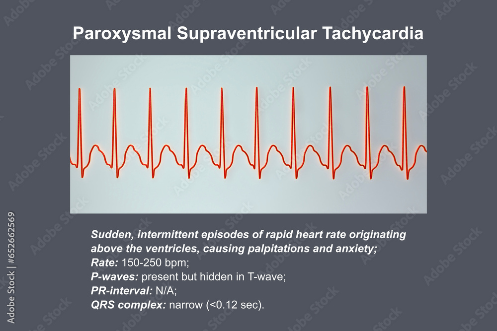ECG in supraventricular tachycardia, 3D illustration Stock Illustration ...