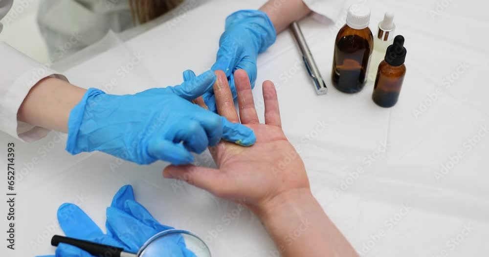 Doctor applies ointment to patient palm. Burn skin treatment Stock ビデオ ...