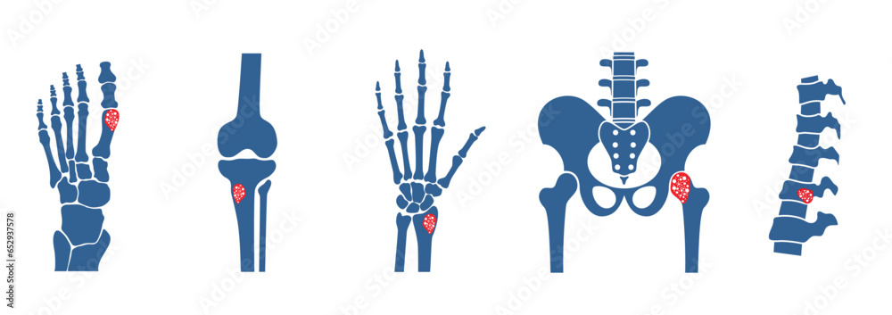 Osteomyelitis disease poster Stock Vector | Adobe Stock
