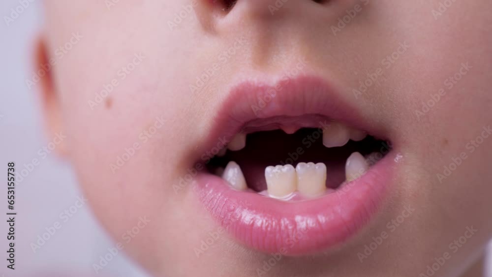 Close-up mouth child has lost one milk teeth. Replacement of permanent ...