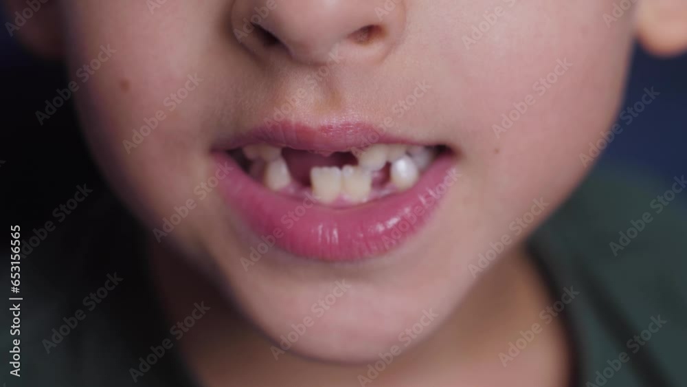 Vidéo Stock Close-up mouth child has lost one milk teeth. Replacement ...