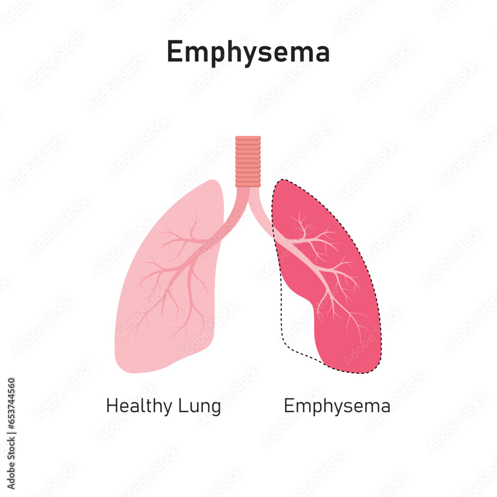 Emphysema Lung Disease Concept Design. Vector Illustration. Stock ... Emphysema Lung Disease Concept Design. Vector Illustration. Stock ...