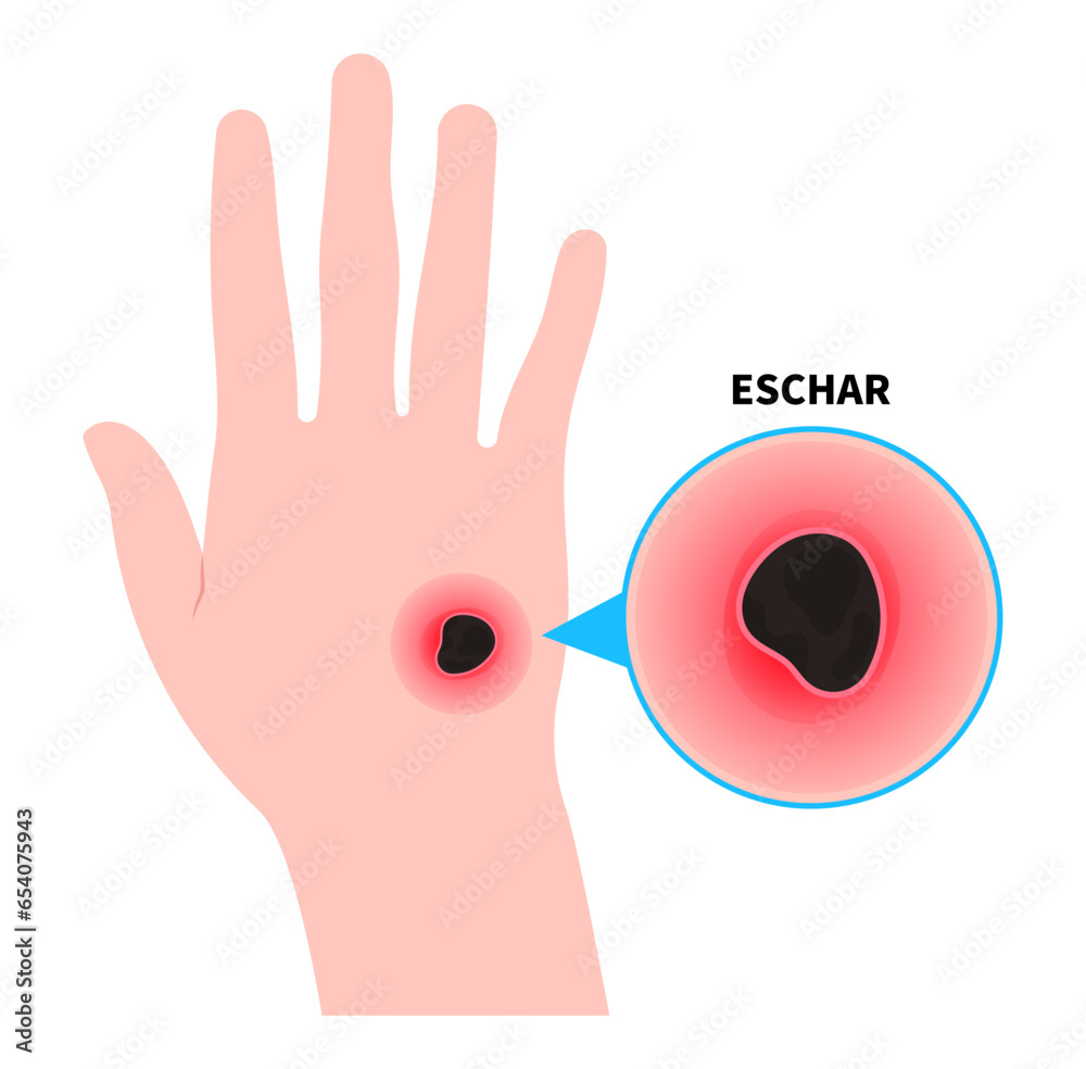 Wounds on hand and skin infection with eschar or scrub typhus the ...