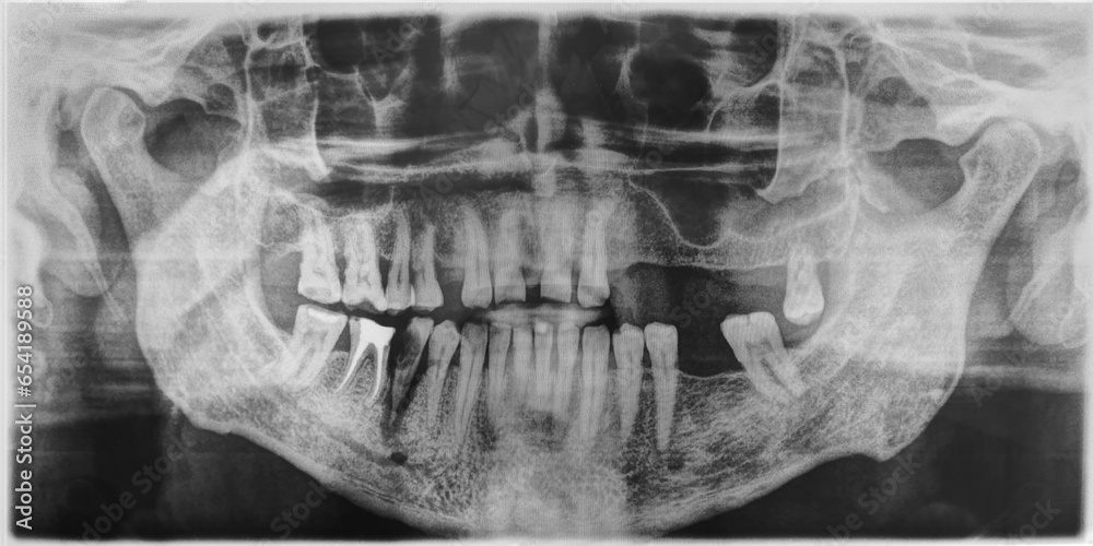 X-ray of bad, decayed teeth. Panoramic x-ray of the jaw and teeth at ...