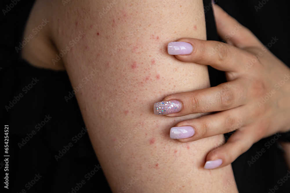 Red rash on the shoulder. Strawberry skin, long pastel pink nail design ...