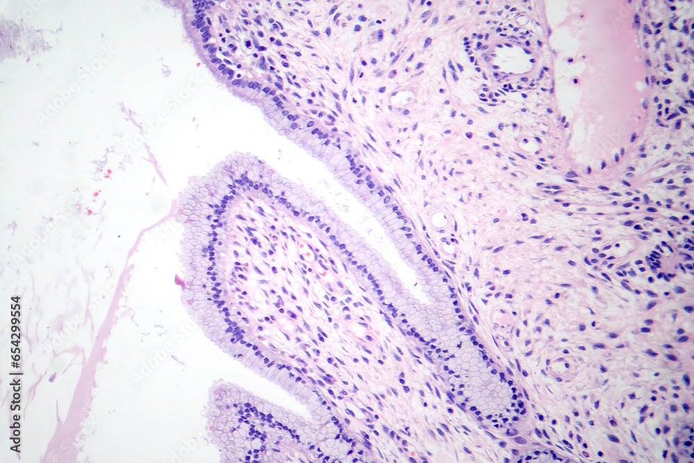 Poster Nasal polyps, light micrograph – Wall Art | UkPosters