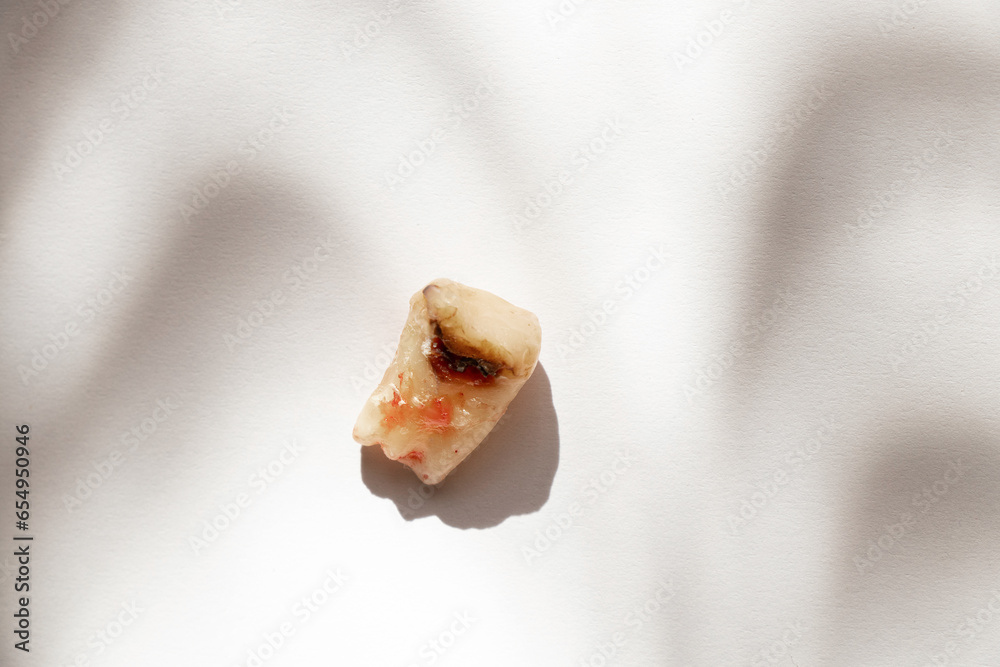 An extracted tooth destroyed with caries and a hole in the middle lies ...