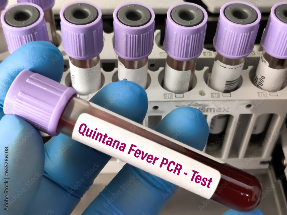 Blood sample for Trench fever also known as five-day fever and quintan ...
