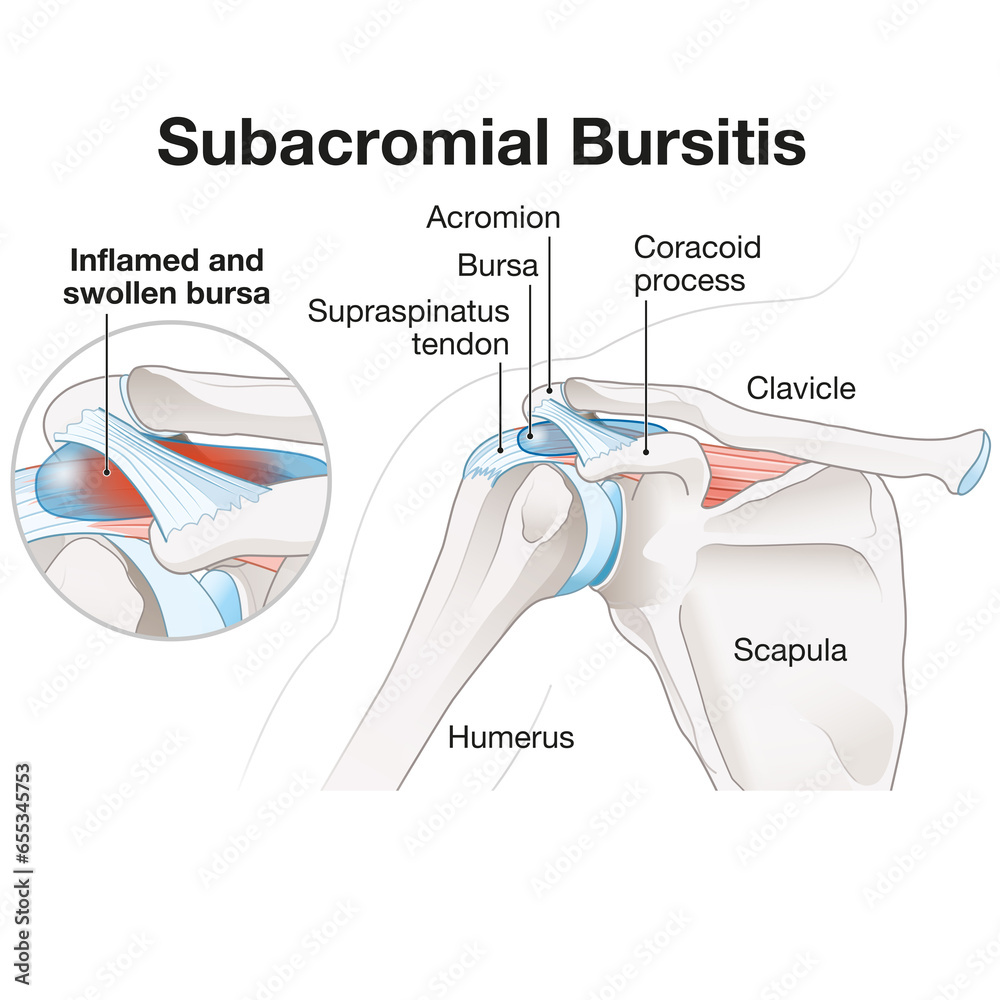 Subacromial bursitis of the shoulder. Medically Illustration. Labeled ...