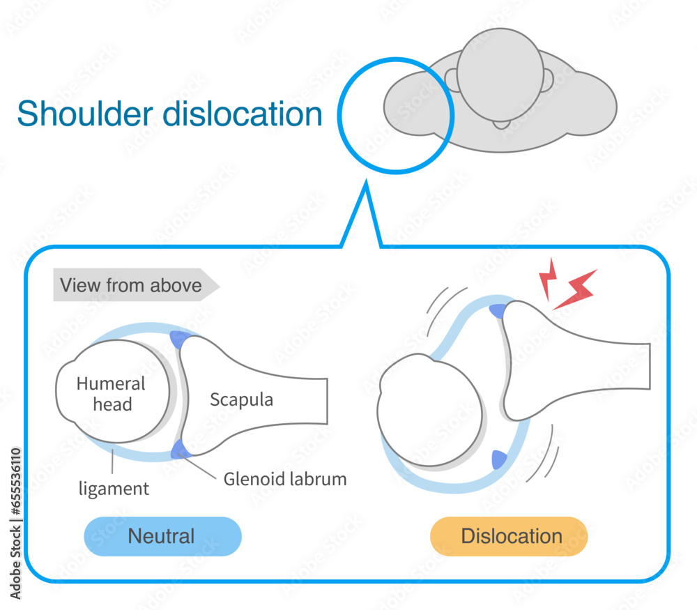 Poster Mechanism and causes of shoulder joint dislocation from above ...