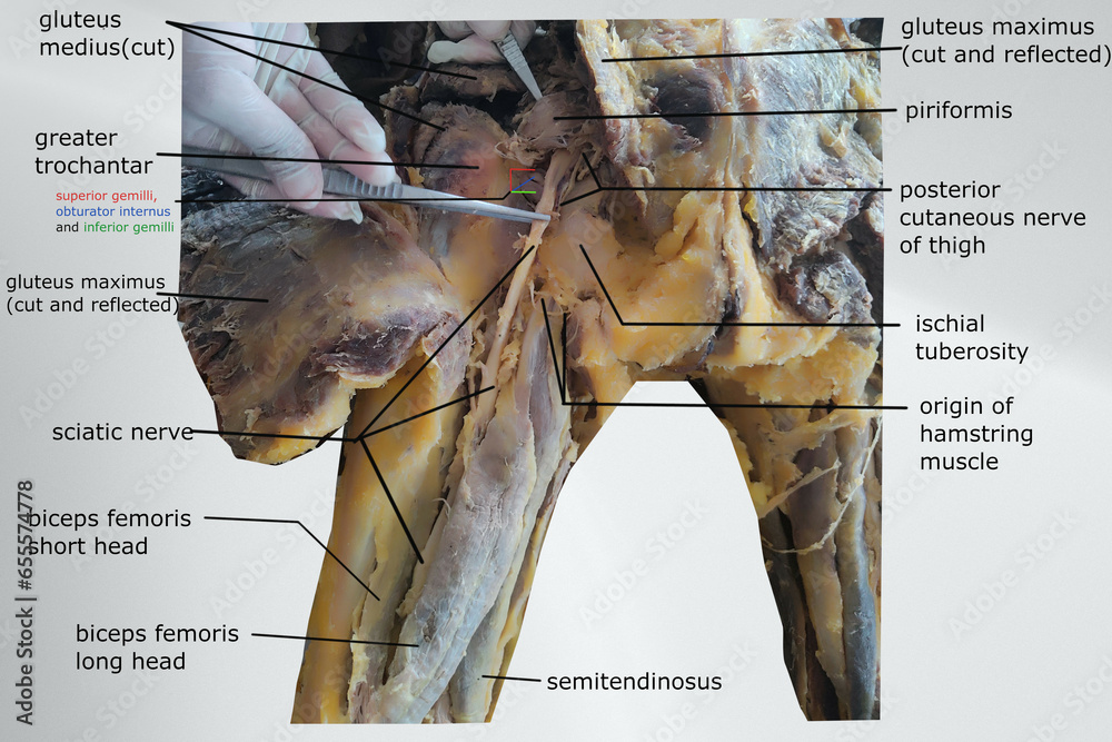 dissection picture of gluteal region showing sciatic nerve course and ...