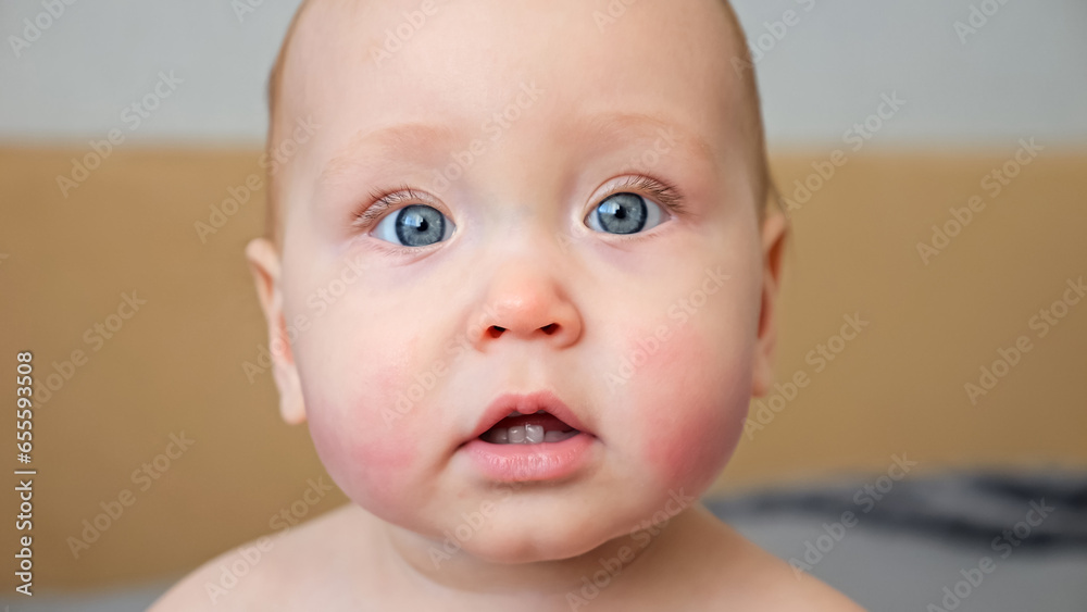 Baby girl with allergic reaction on cheekbones looks around with ...